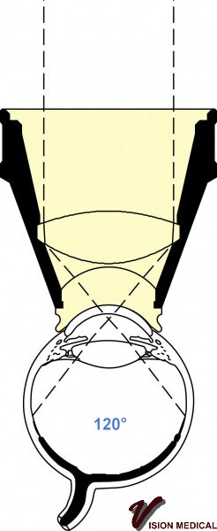 Ocular PDT 1.6X (OPDT )